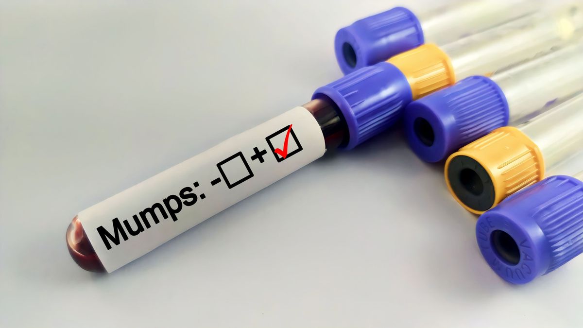 Egy súlyos betegség, mumpsz gyanúja Vasban!